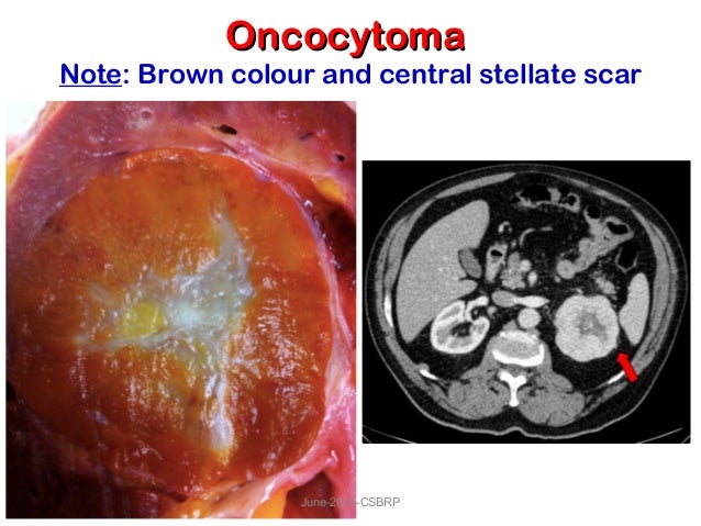 Kidney tumors csbrp
