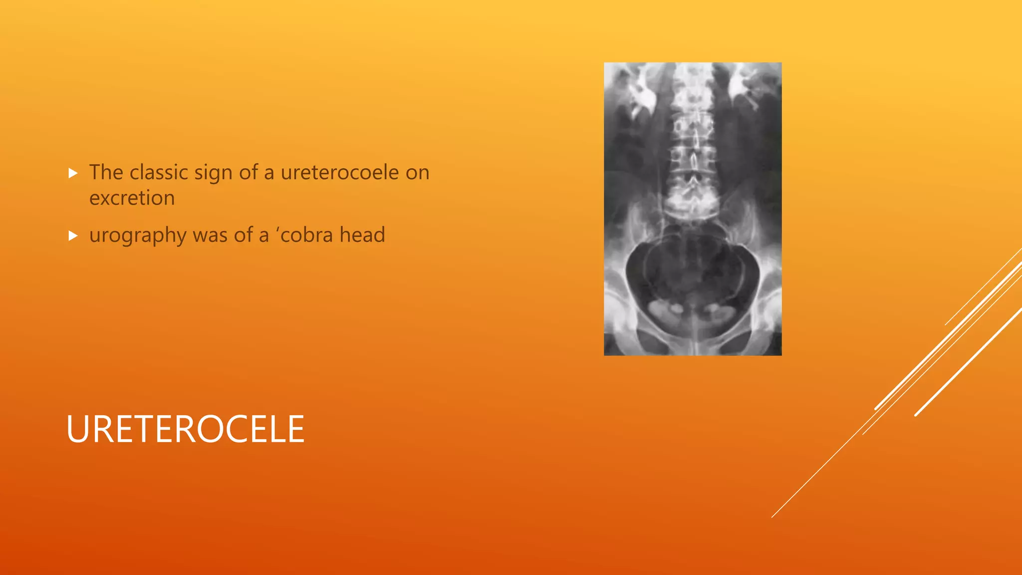 Kidney & ureter Common surgical problems | PPTX | Digestive Disorders ...