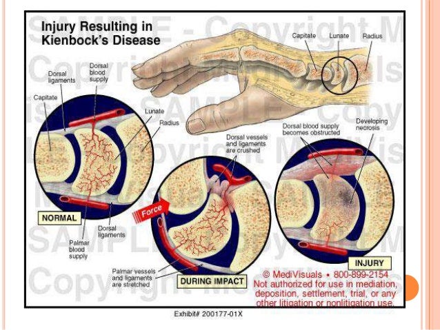 Kienbock disease os osteonecrosis of lunate