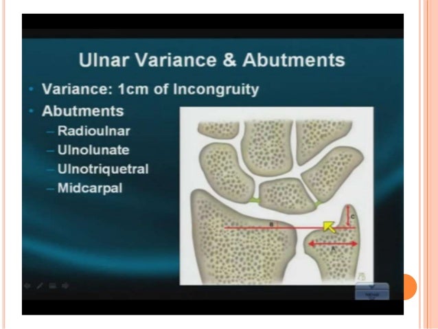Kienbock disease os osteonecrosis of lunate