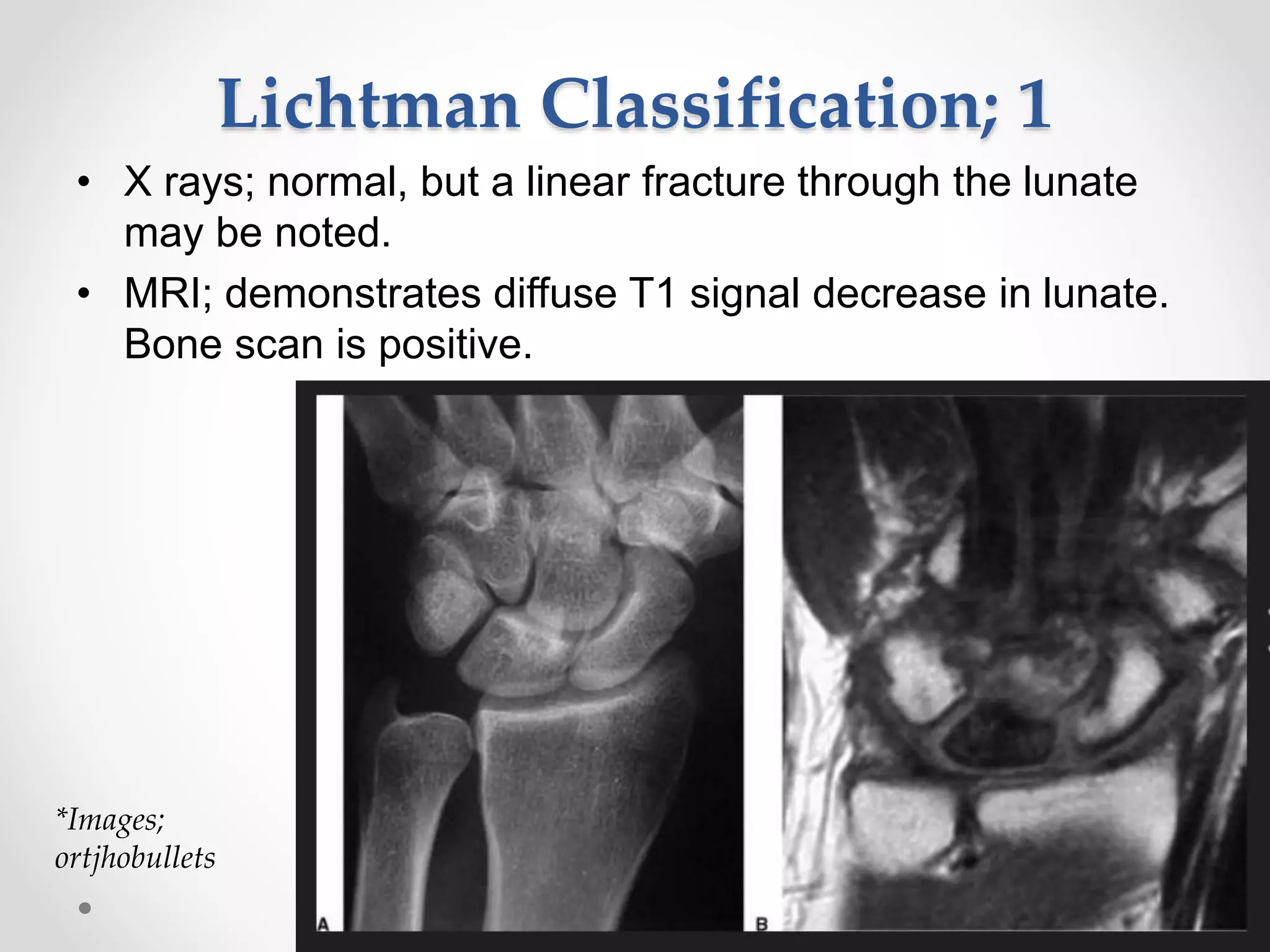 Kienbock's disease | PPTX