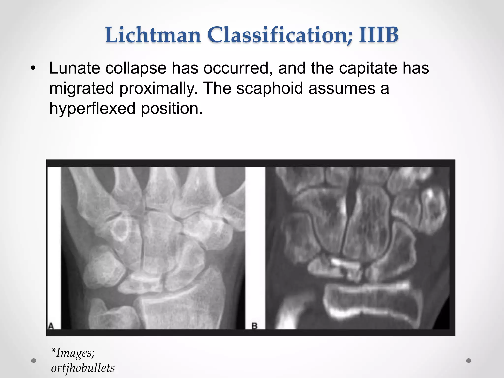 Kienbock's disease | PPTX