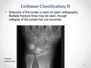 Kienbock's disease | PPT