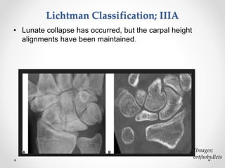 Kienbock's disease | PPT