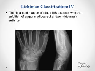 Kienbock's disease | PPT