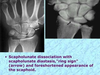 Kienbock's disease.ppt