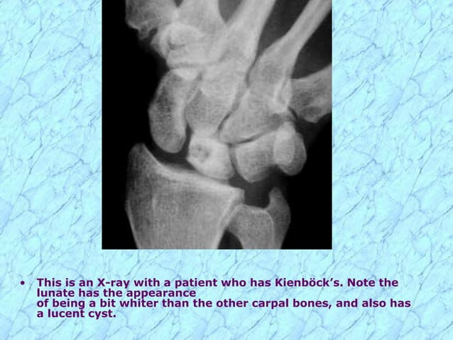 Kienbock's disease.ppt