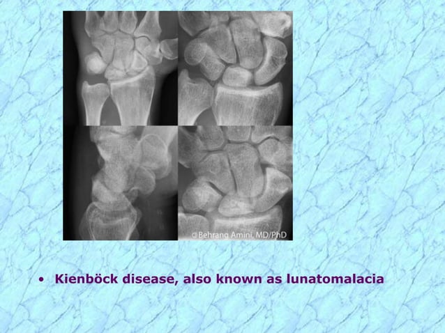 Kienbock's disease.ppt