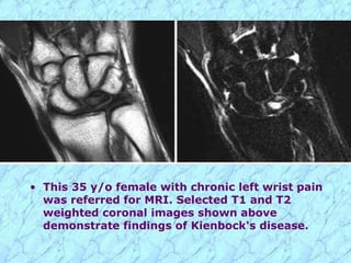 Kienbock's disease.ppt