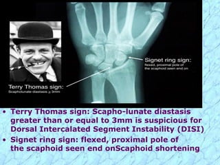 Kienbock's disease.ppt