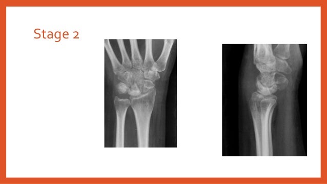 Lichtman's Radiographic Classification Of Kienbock's Disease ...