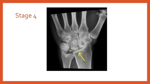 Lichtman's Radiographic Classification Of Kienbock's Disease ...
