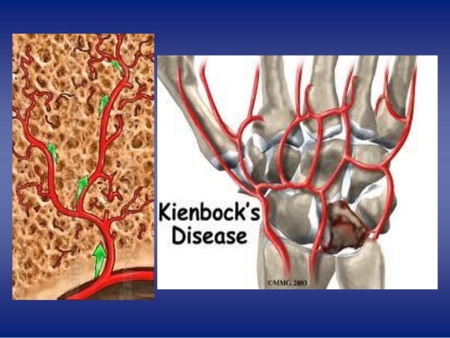 Kienbock,s diseases