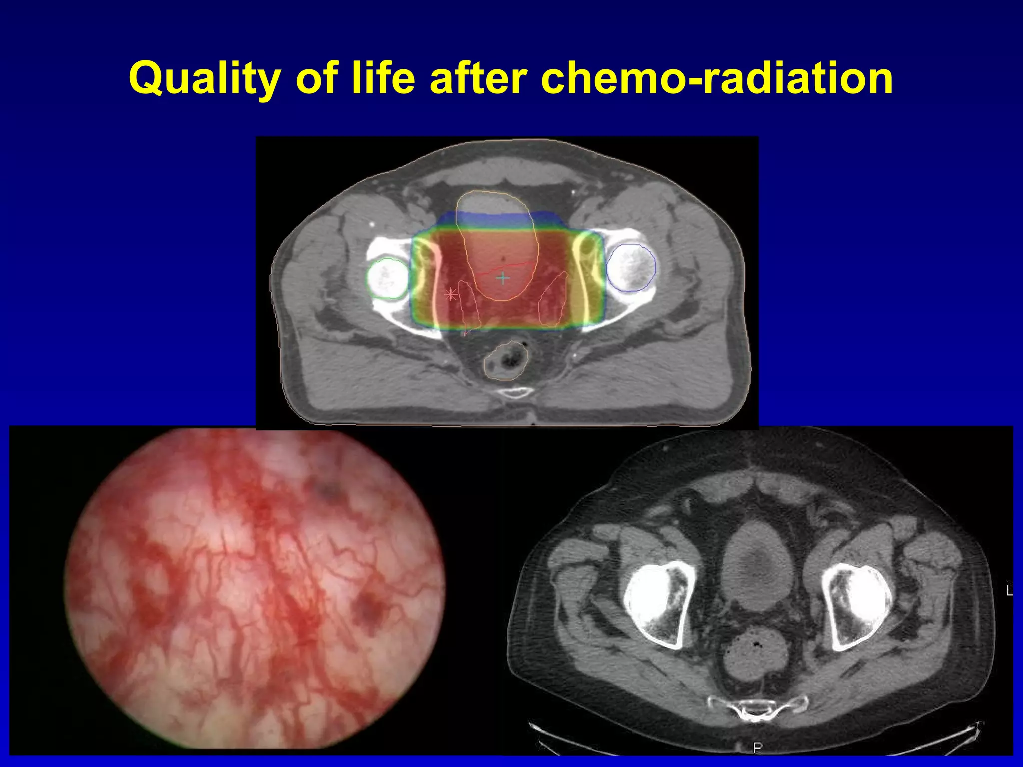 Bladder-Sparing Trimodality Therapy for Muscle-Invasive Bladder Cancer ...