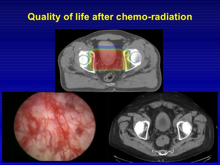 Bladder Sparing Trimodality Therapy For Muscle Invasive Bladder Cancer