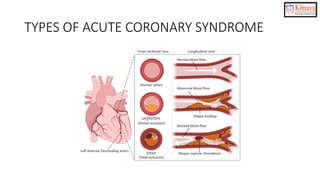 ACUTE CORONARY SYNDROME AND ITS BASICS WITH SYMPTOMATOLOGY AND PRIMARY ...