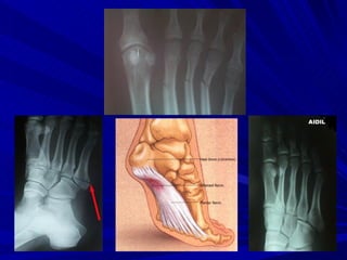 Kin 188 Foot, Ankle And Leg Injuries | PPT