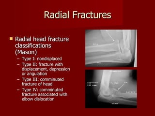Kin 191 B – Elbow And Forearm Pathologies | PPT