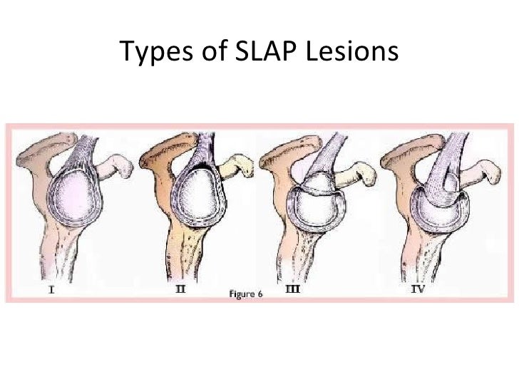 Kin 191 B – Shoulder Injuries