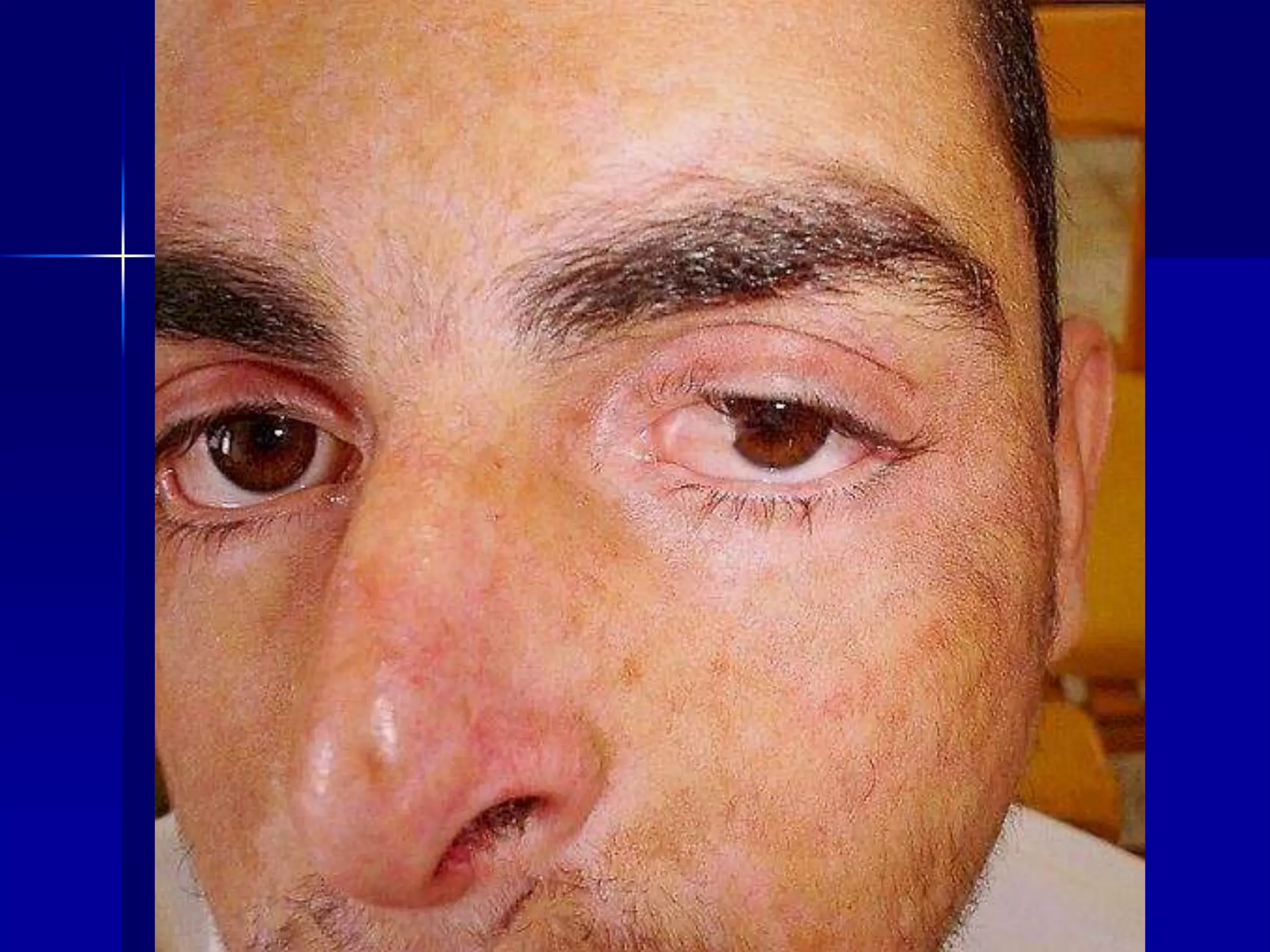 Kindler syndrome: A case presentation. | PPTX