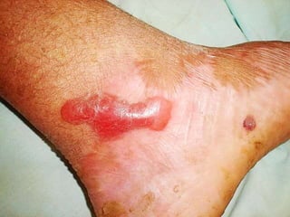 Kindler Syndrome A Case Presentation Pptx