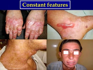 Kindler syndrome: A case presentation. | PPTX