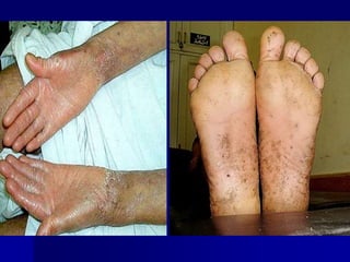 Kindler syndrome: A case presentation. | PPTX