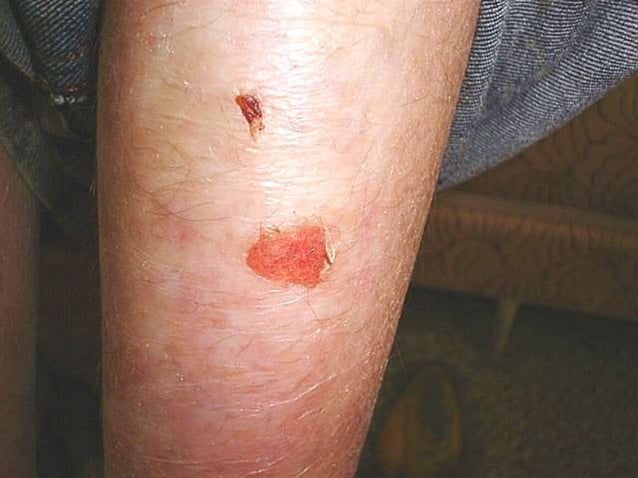 Kindler syndrome: A case presentation. | PPT