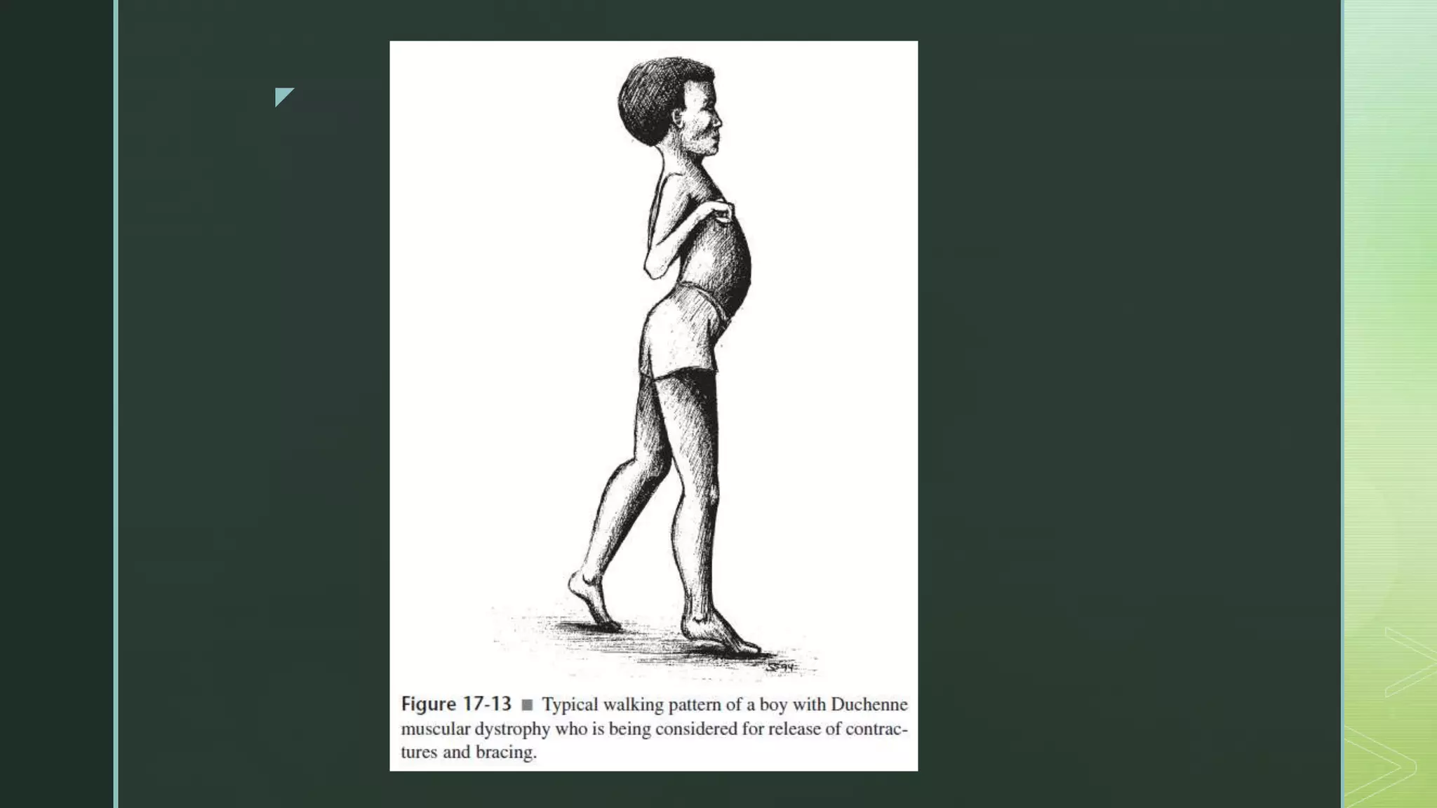 Kinetics and kinematics of posture in DMD | PPTX