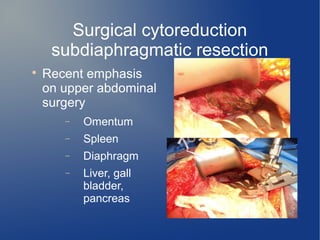 The Role of Surgery in the Management of Ovarian Cancer | PPT