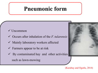 Pneumonic Tularemia