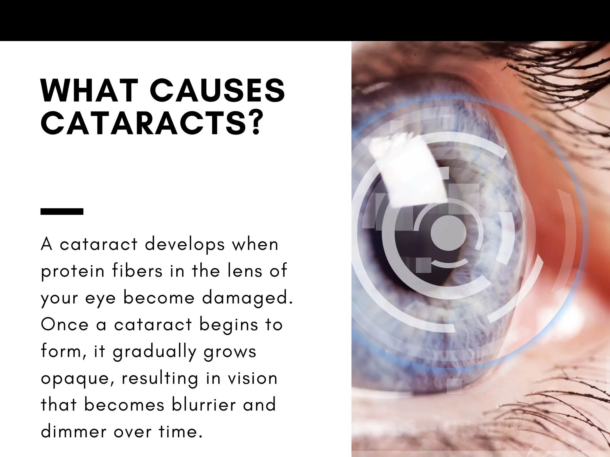 Understanding Cataracts | PPT