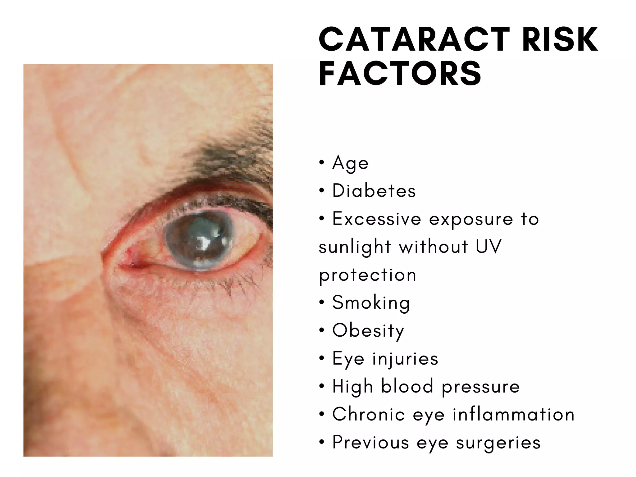 Understanding Cataracts | PPT