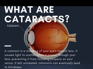 Understanding Cataracts | PDF