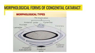 Congenital Cataract | PPTX