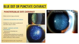 Congenital Cataract | PPT