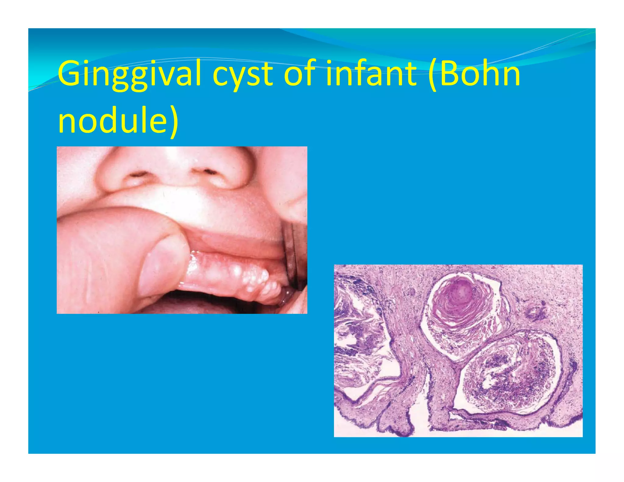 KISTA PADA RONGGA MULUT PPT.pdf