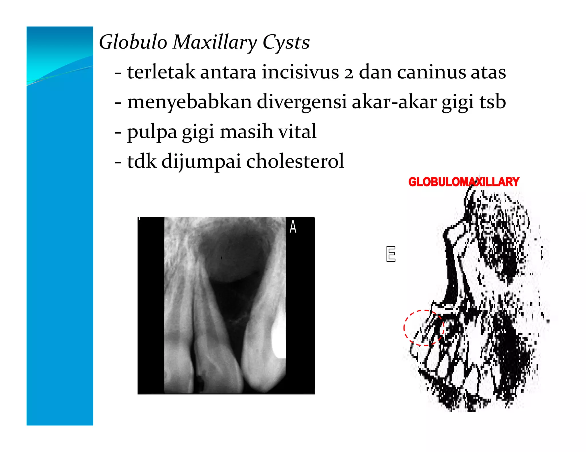 KISTA PADA RONGGA MULUT PPT.pdf