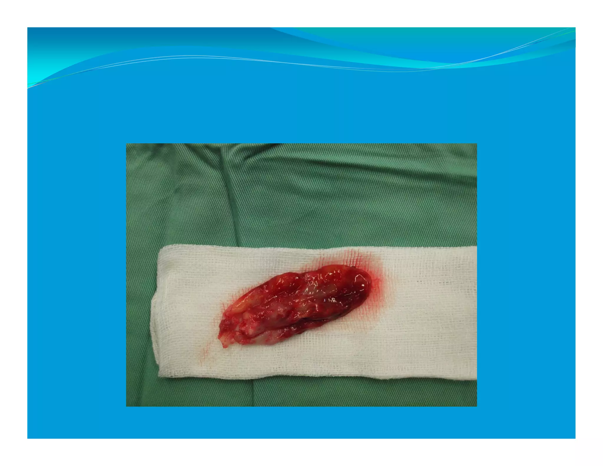 KISTA PADA RONGGA MULUT PPT.pdf