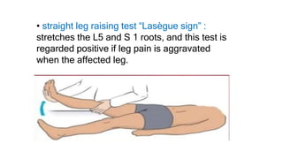 a study on sciatica | PPTX