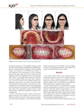 잇몸웃음과 치아교정 Kjo article | PDF