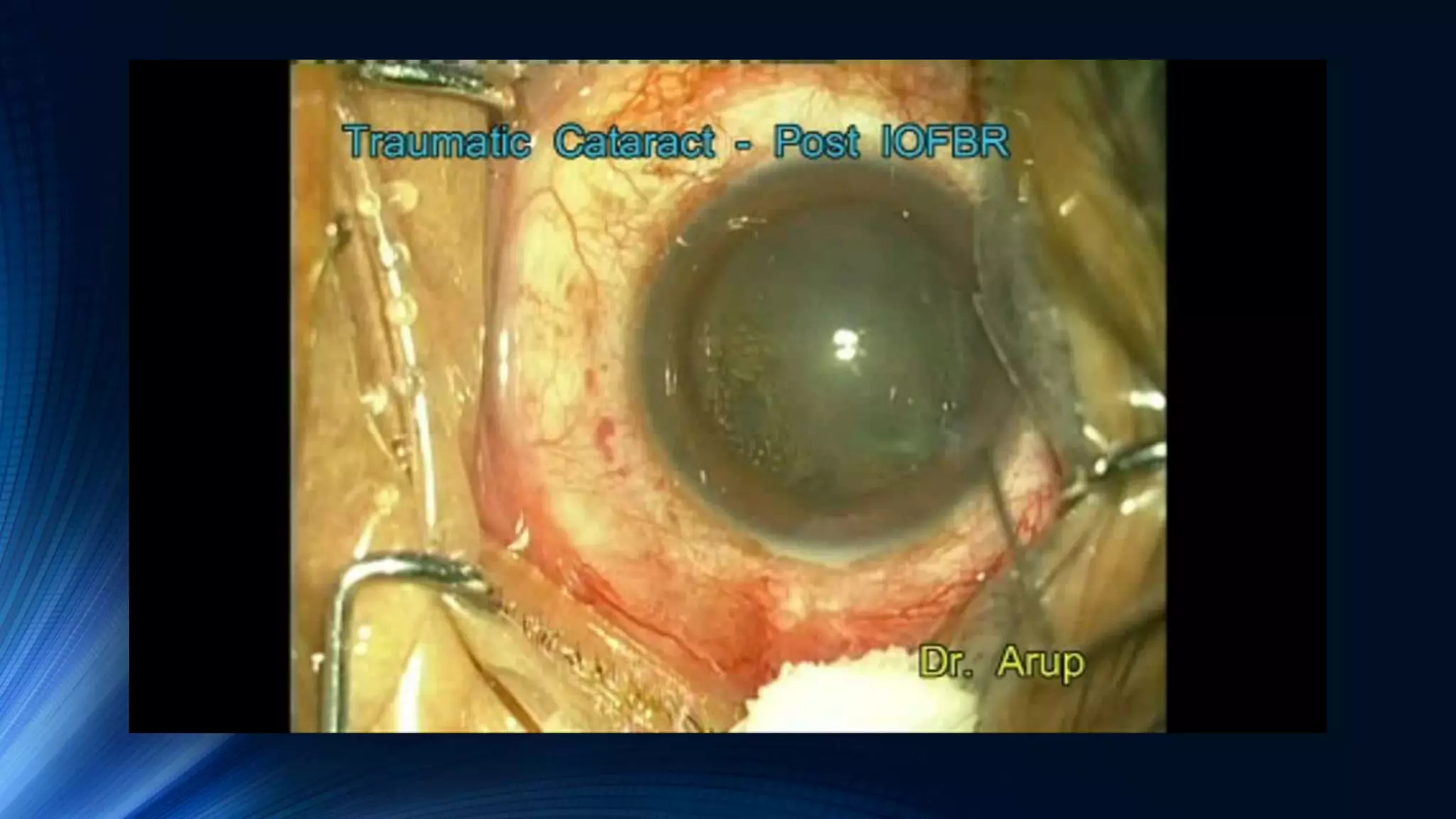 Occult Posterior capsular rent | PPTX