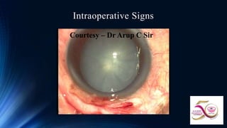 Occult Posterior capsular rent | PPTX