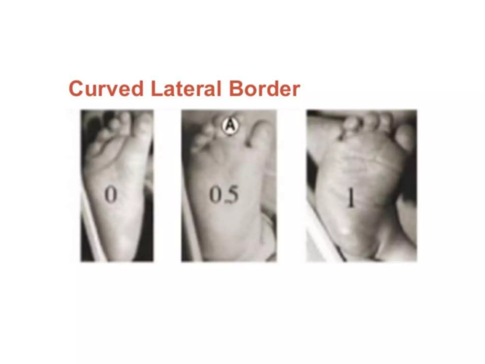 CTEV Imaging, Classification, Pirani scoring system, conservative ...