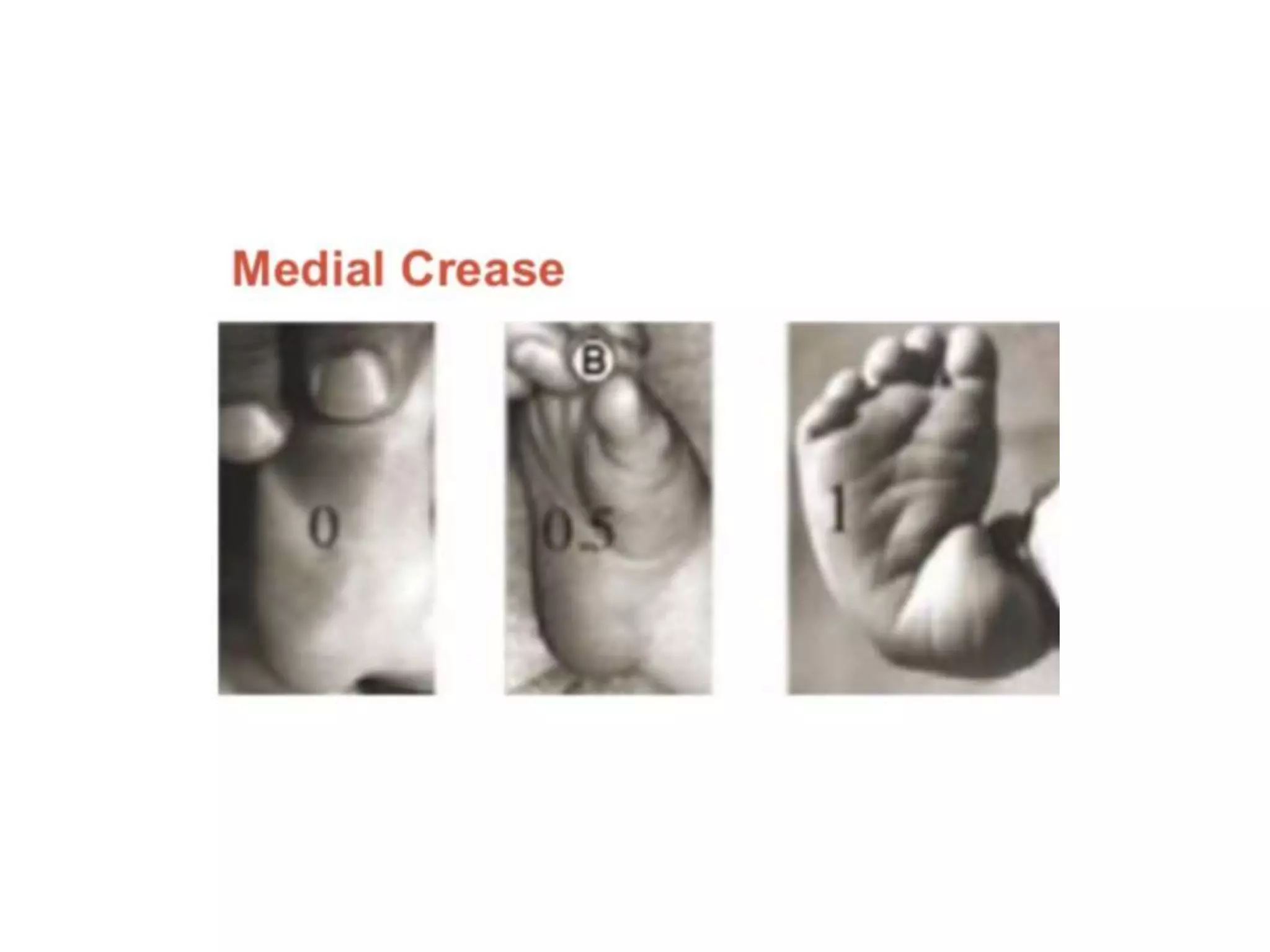 CTEV Imaging, Classification, Pirani scoring system, conservative ...