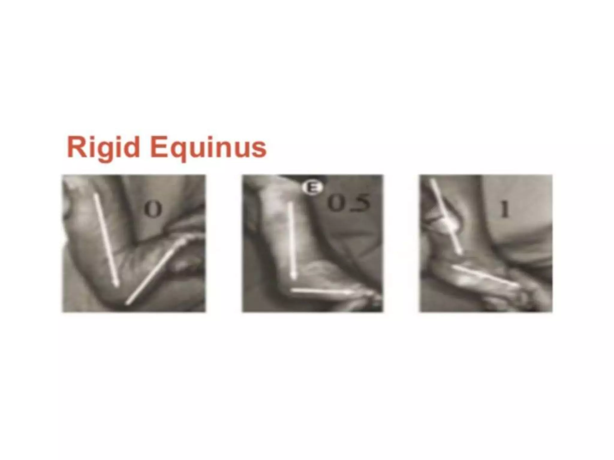 CTEV Imaging, Classification, Pirani scoring system, conservative ...