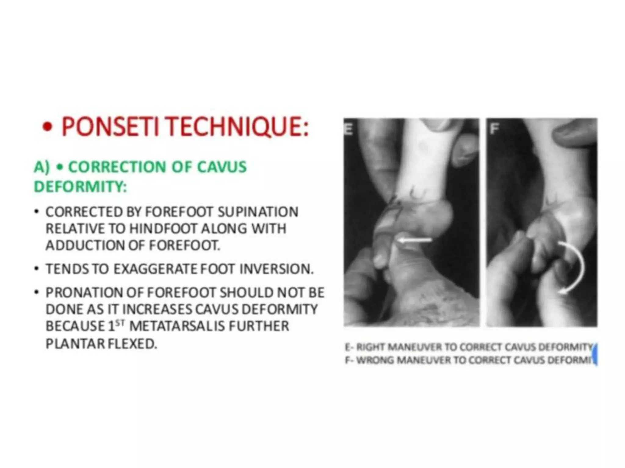 CTEV Imaging, Classification, Pirani scoring system, conservative ...