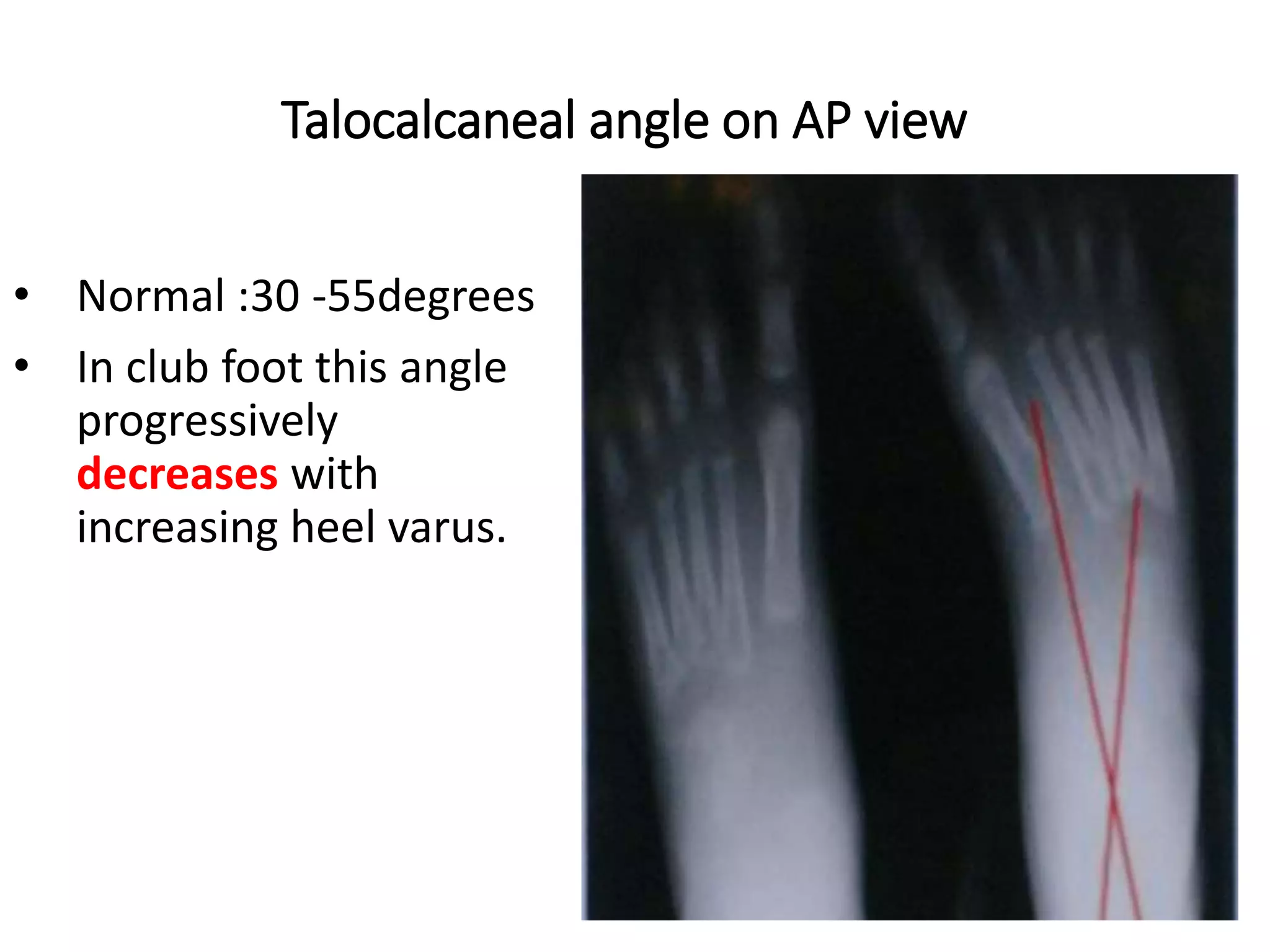 CTEV Imaging, Classification, Pirani scoring system, conservative ...