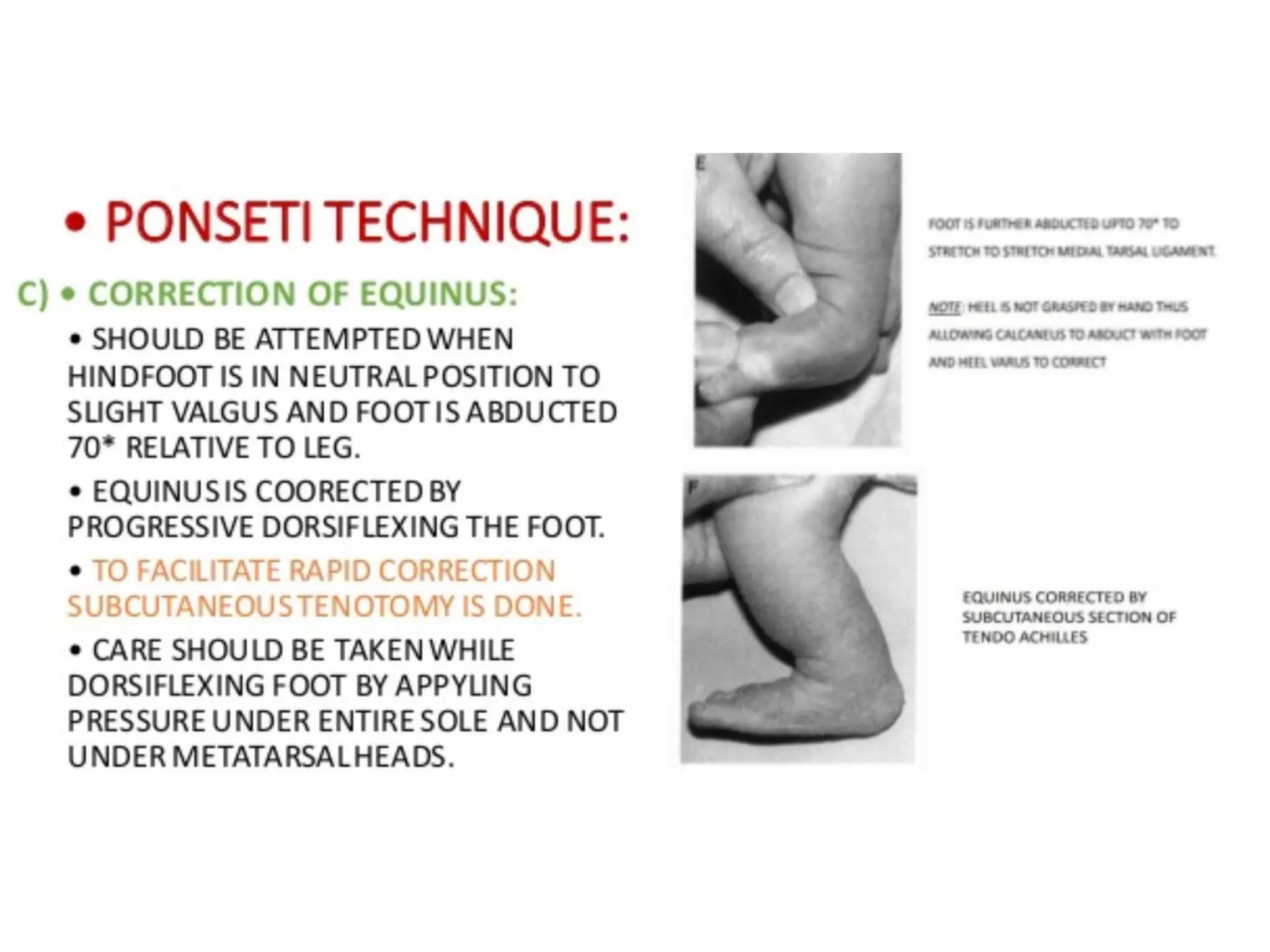 CTEV Imaging, Classification, Pirani scoring system, conservative ...