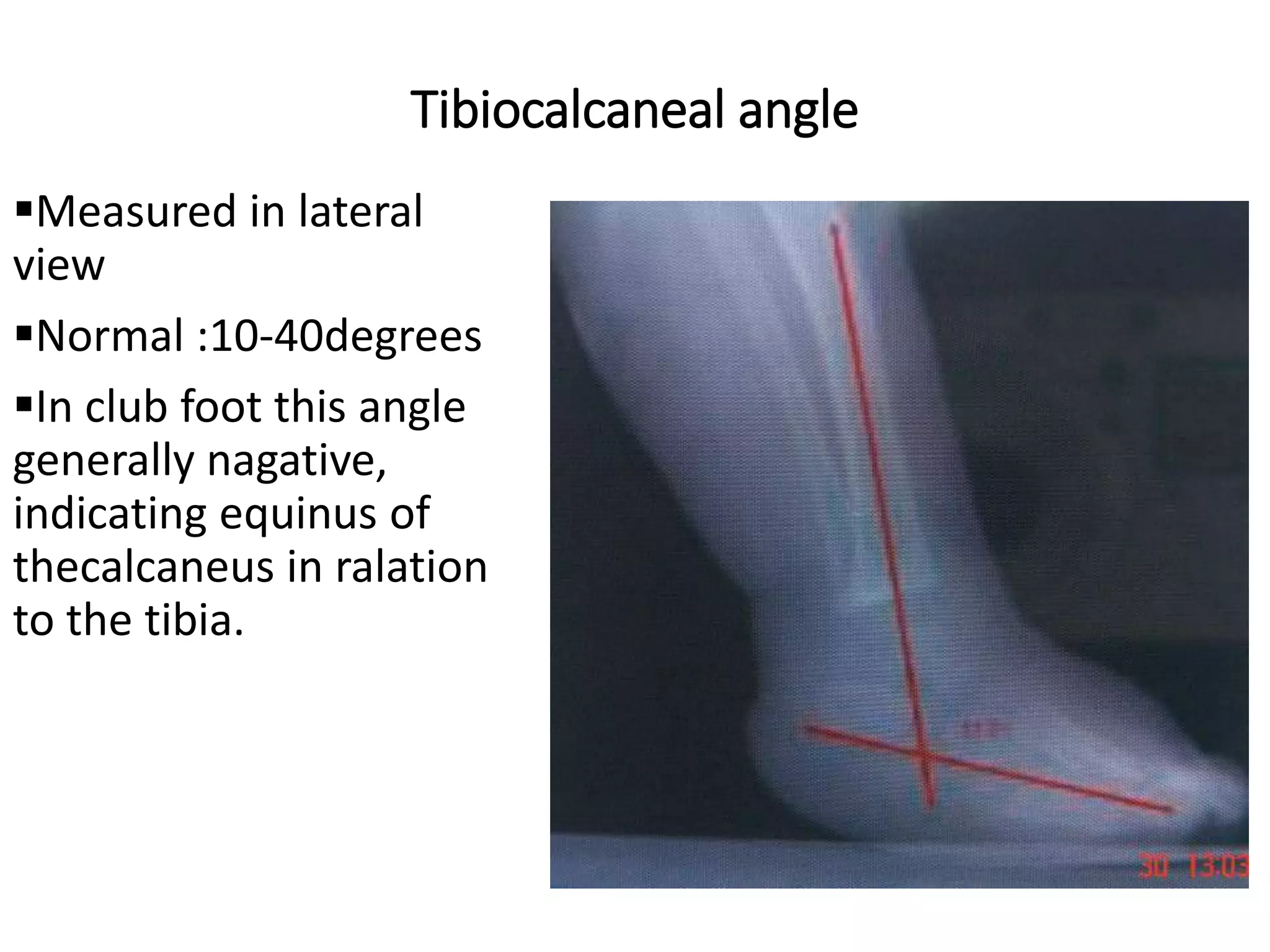 CTEV Imaging, Classification, Pirani scoring system, conservative ...